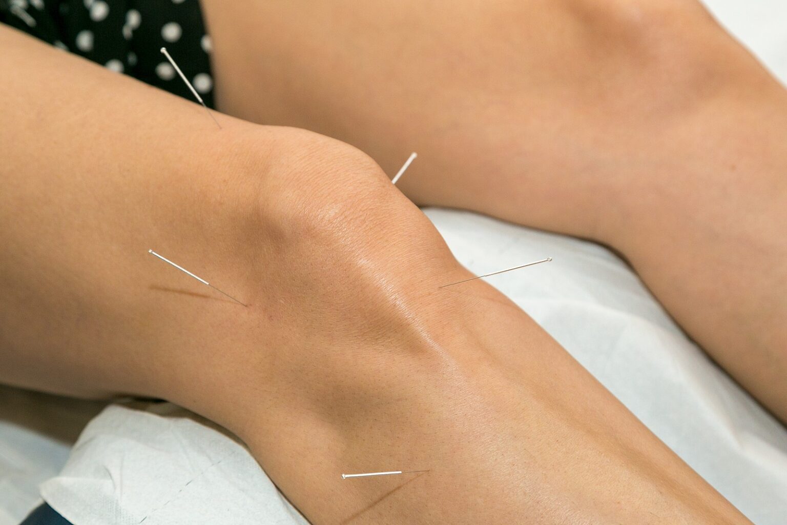 Does Acupuncture Hurt? What No One Tells You Does Acupuncture Hurt ...